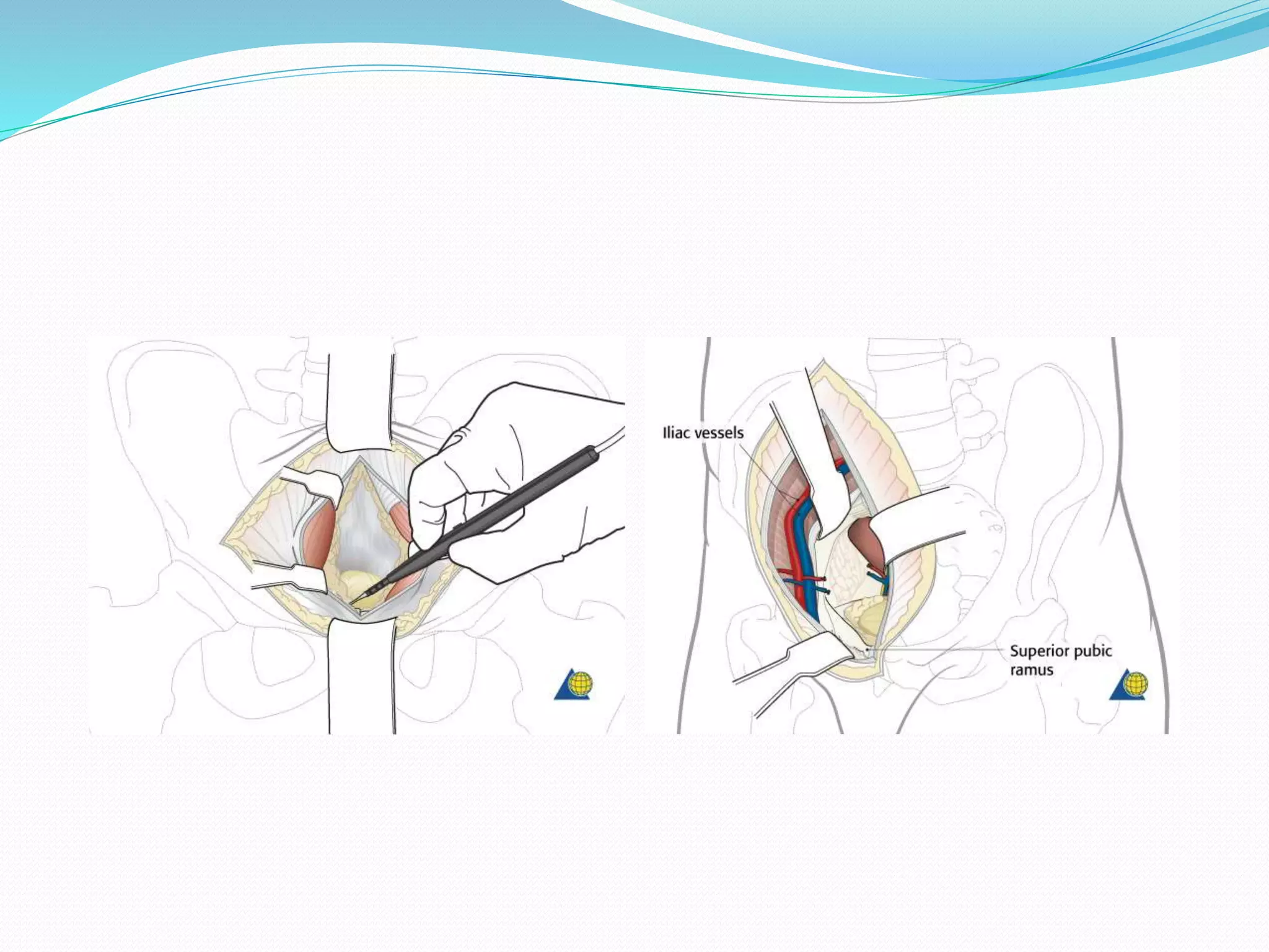 Approach to acetabulum fracture zoom 2020 | PPTX