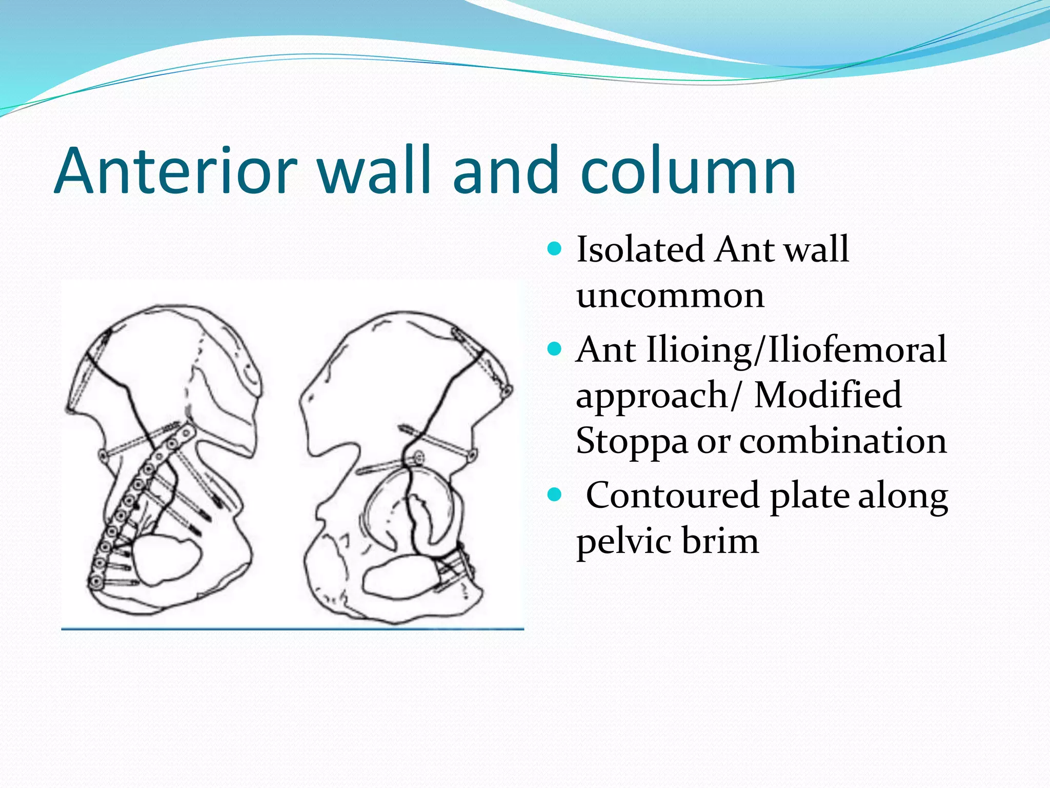 Approach to acetabulum fracture zoom 2020 | PPTX