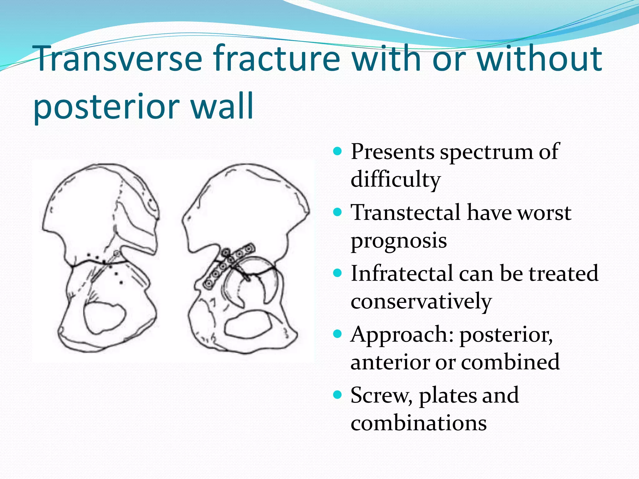Approach to acetabulum fracture zoom 2020 | PPTX