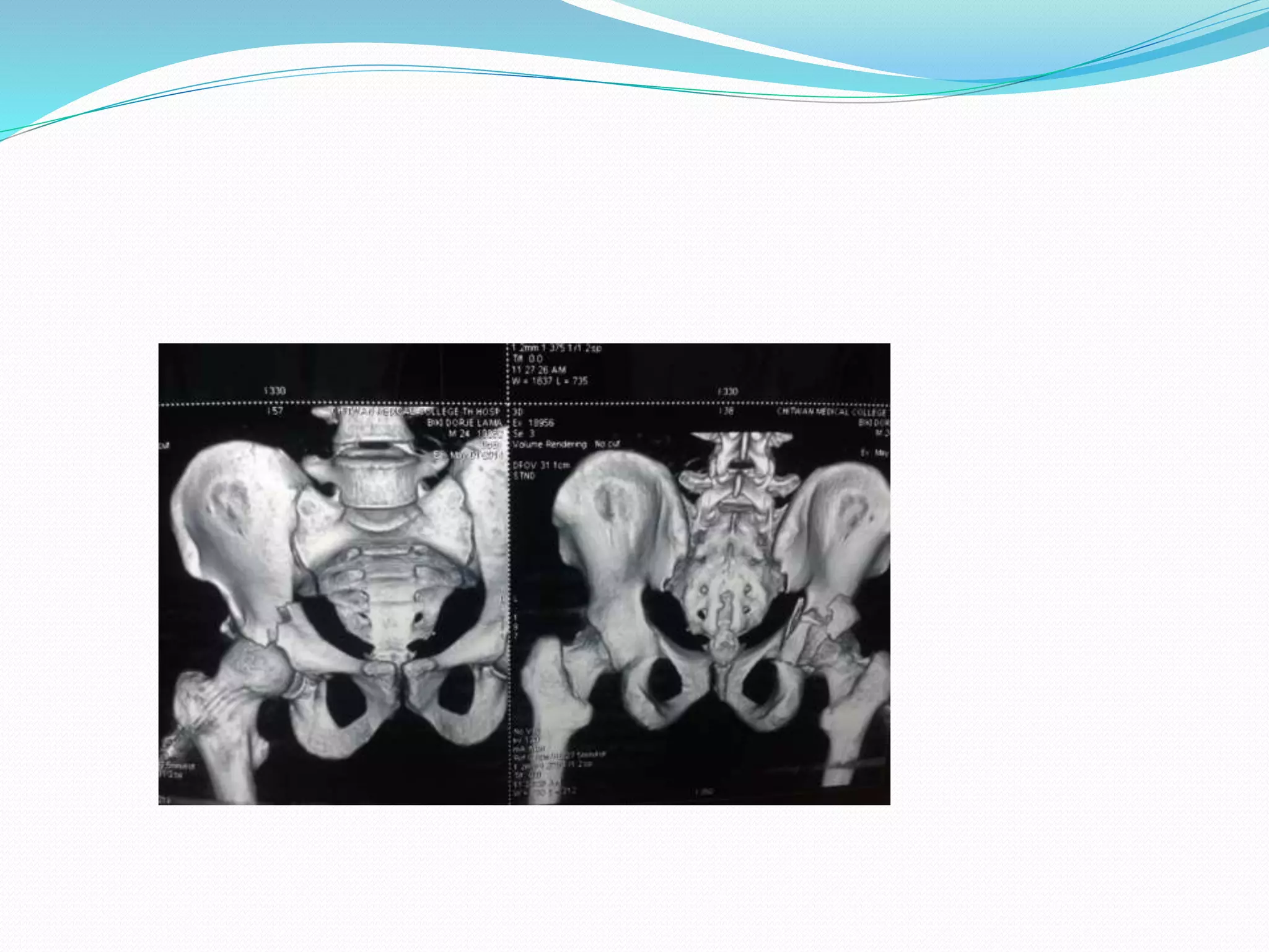 Approach to acetabulum fracture zoom 2020 | PPTX