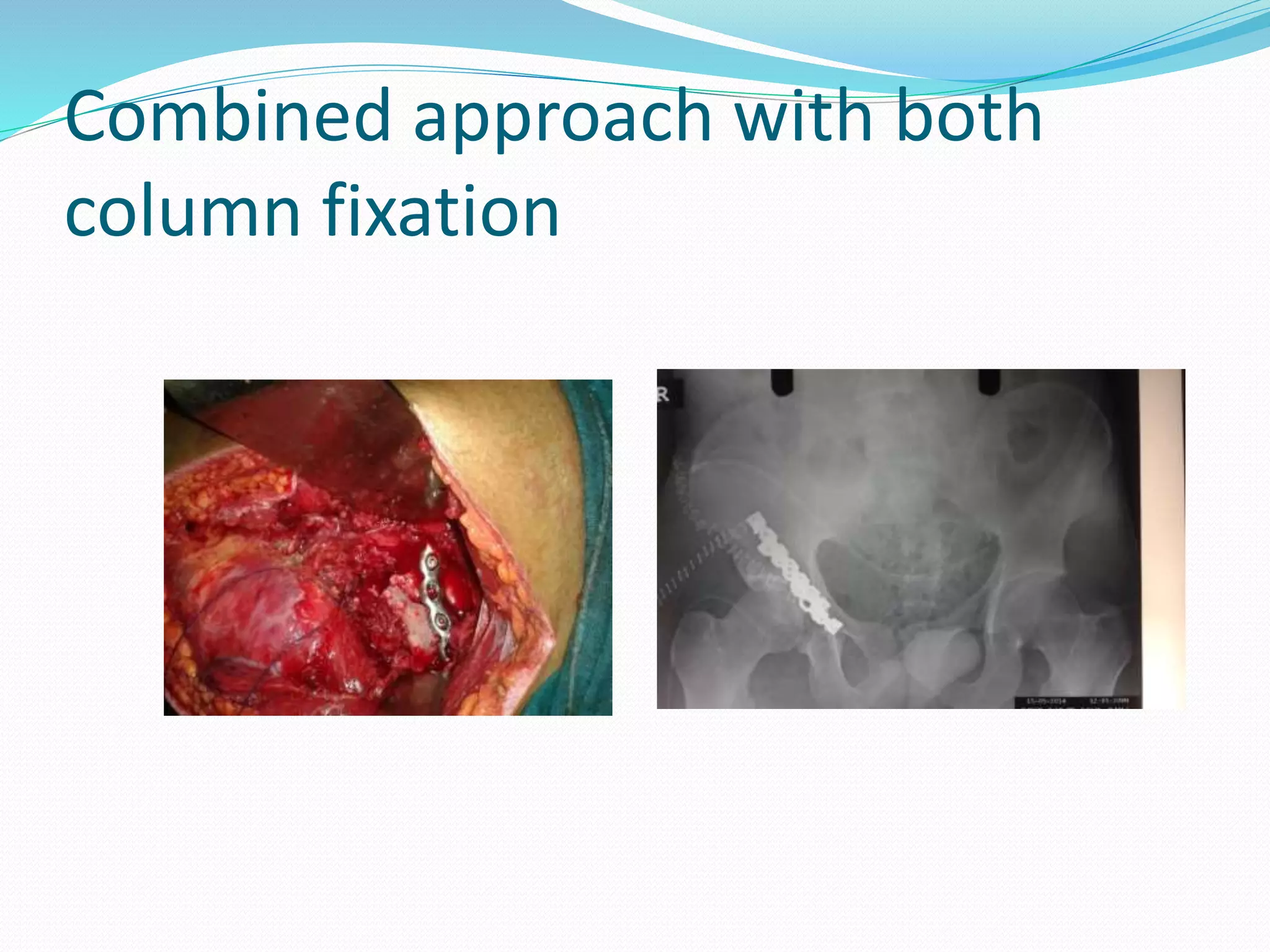 Approach to acetabulum fracture zoom 2020 | PPTX