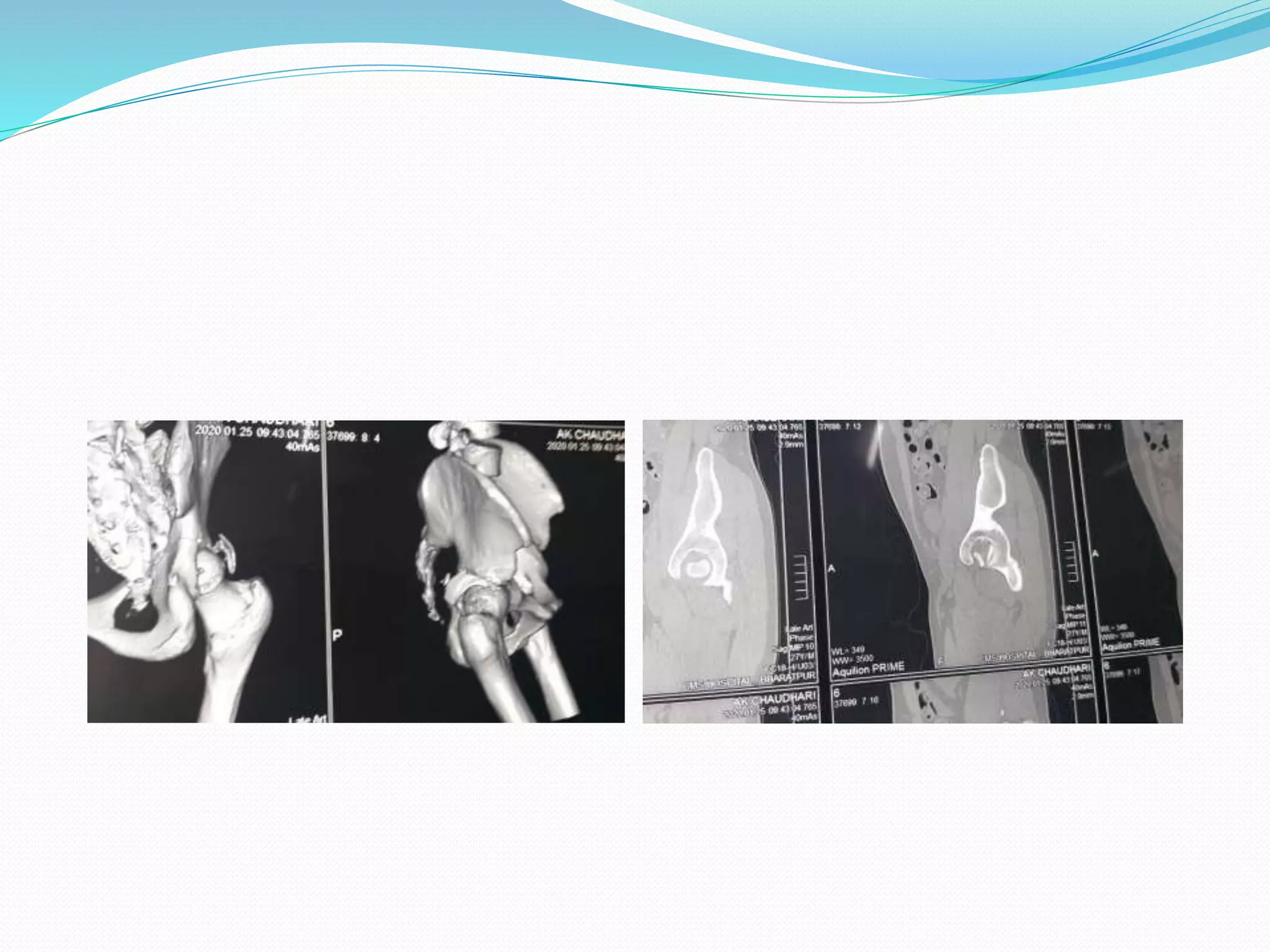 Approach to acetabulum fracture zoom 2020 | PPTX