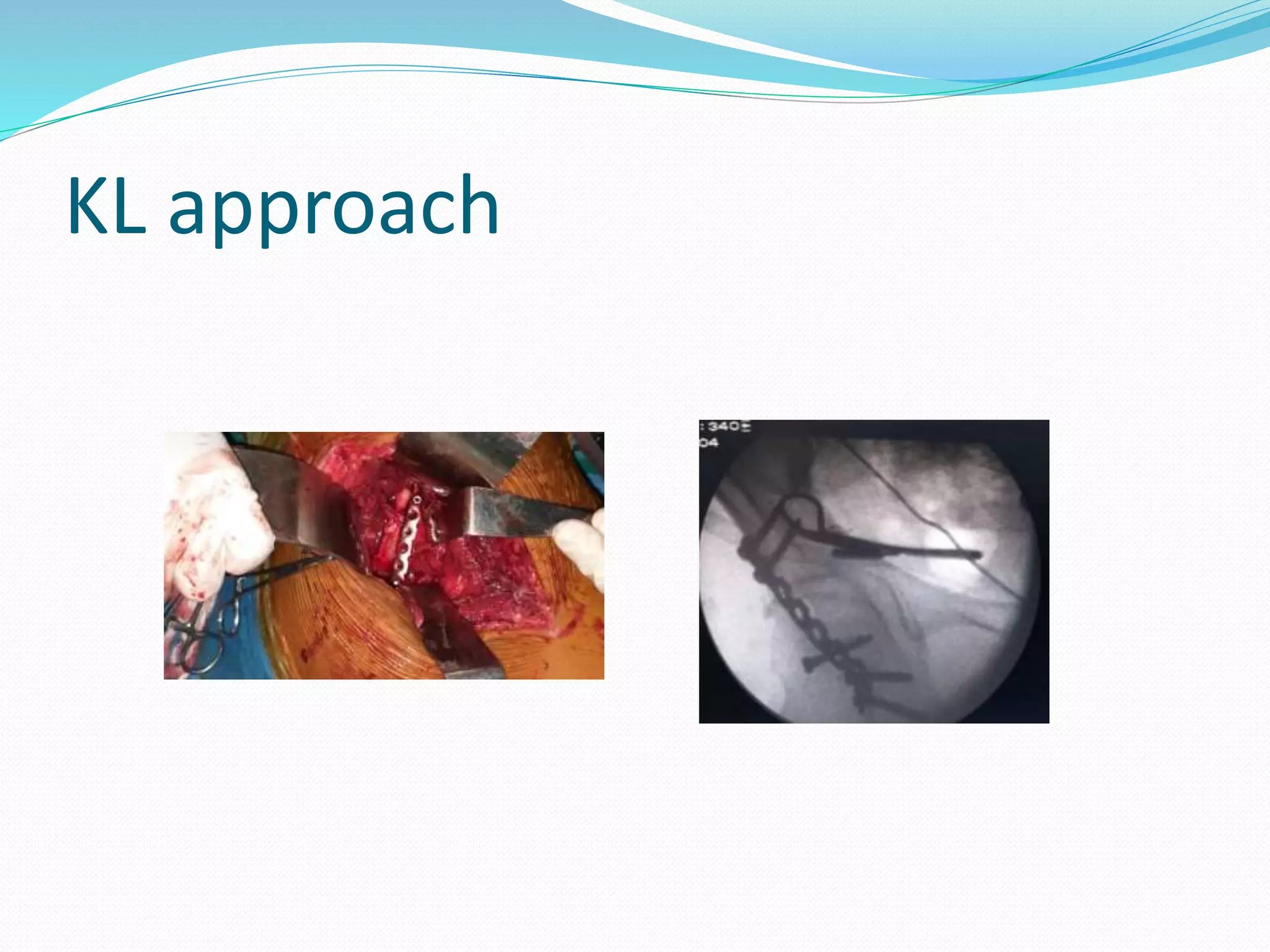 Approach to acetabulum fracture zoom 2020 | PPTX