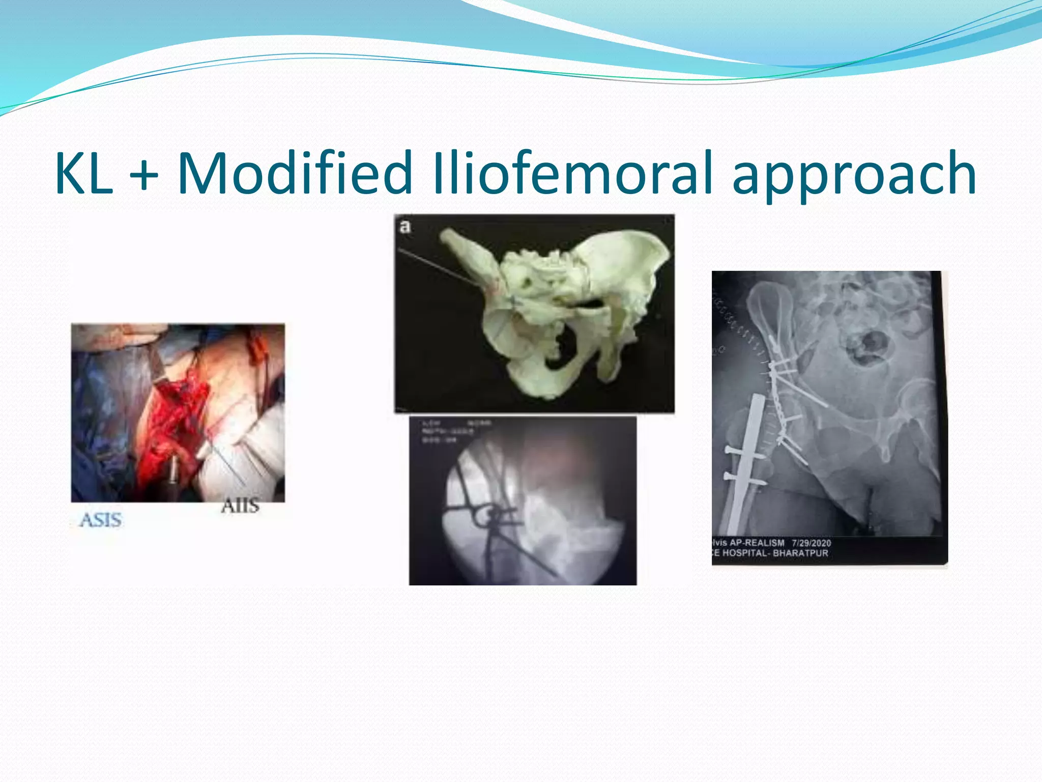 Approach to acetabulum fracture zoom 2020 | PPTX