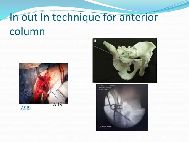 Approach to acetabulum fracture zoom 2020 | PPT