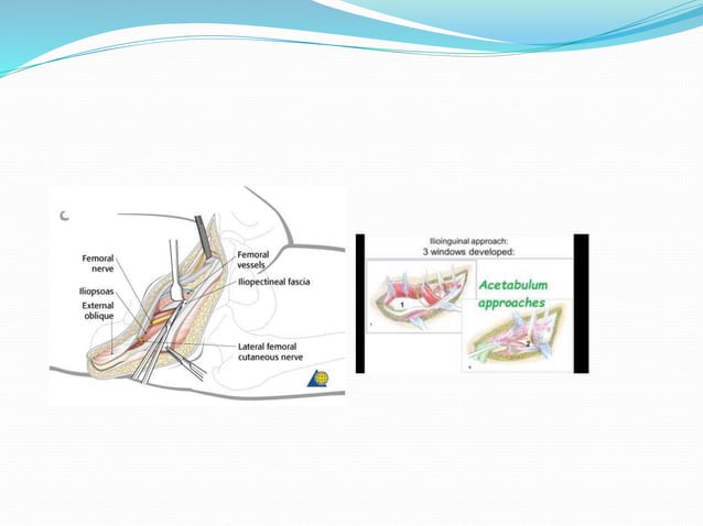 Approach to acetabulum fracture zoom 2020 | PPT