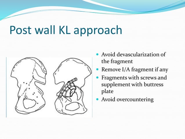 Approach to acetabulum fracture zoom 2020 | PPT