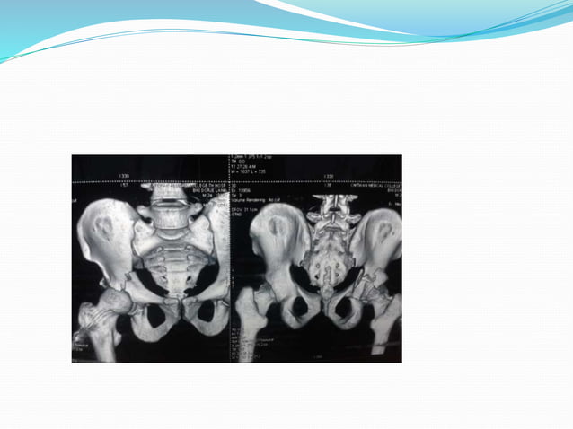 Approach to acetabulum fracture zoom 2020 | PPT
