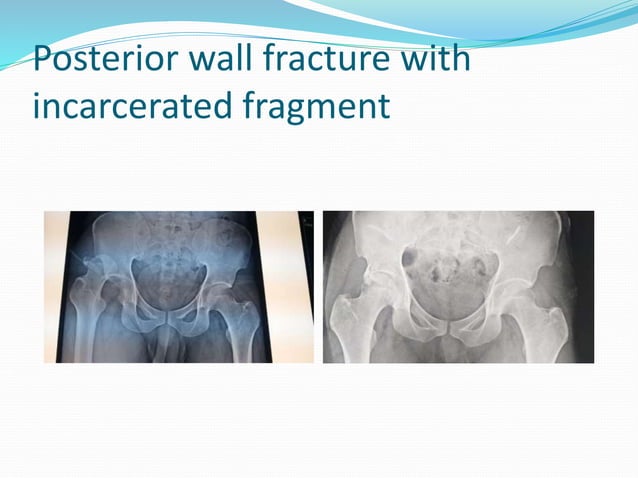 Approach to acetabulum fracture zoom 2020 | PPT