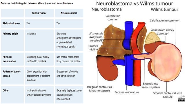 Approach to a Child with an Abdominal Mass and tumours.pptx
