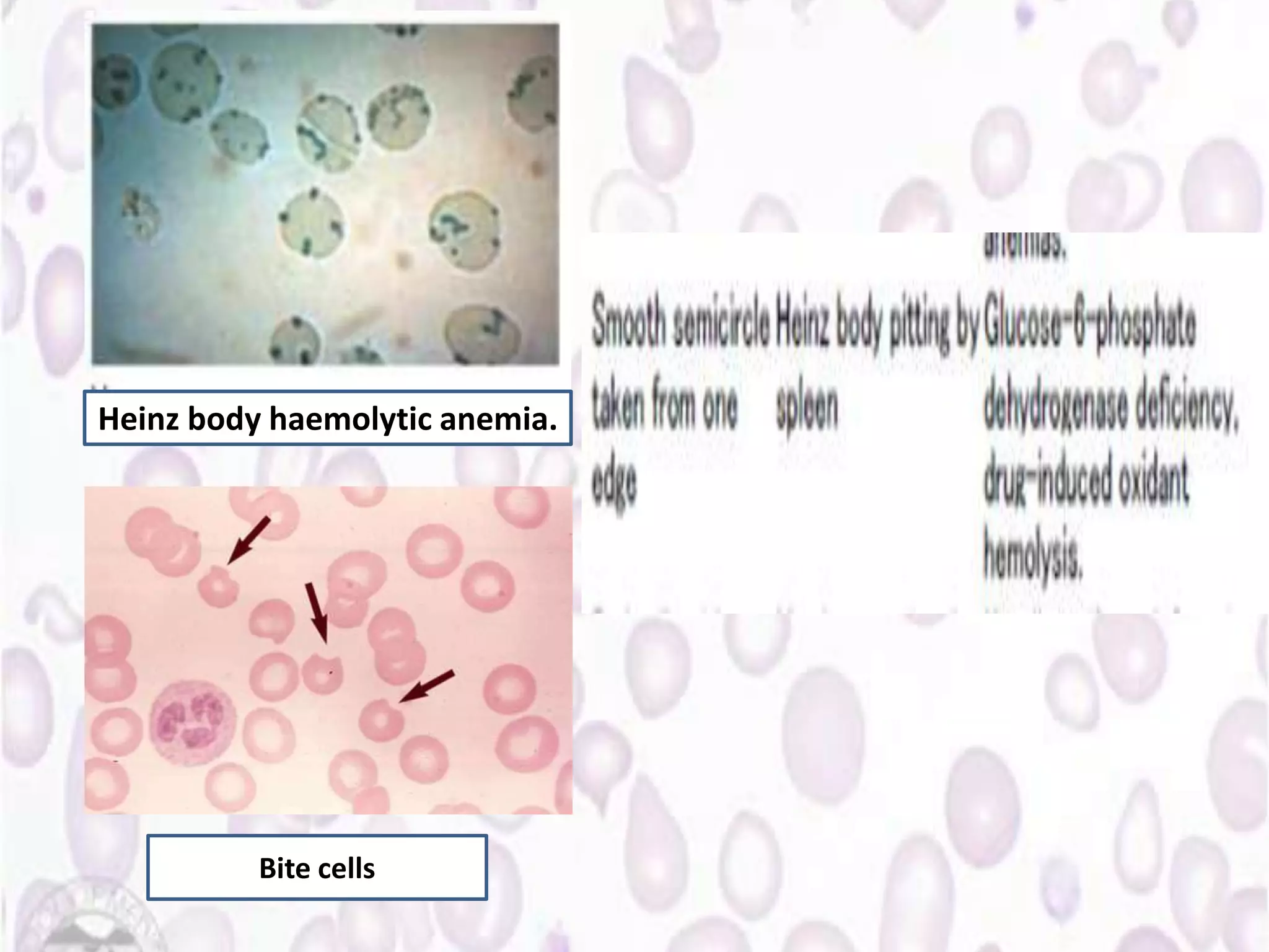 a child with anaemia - an approach | PPTX