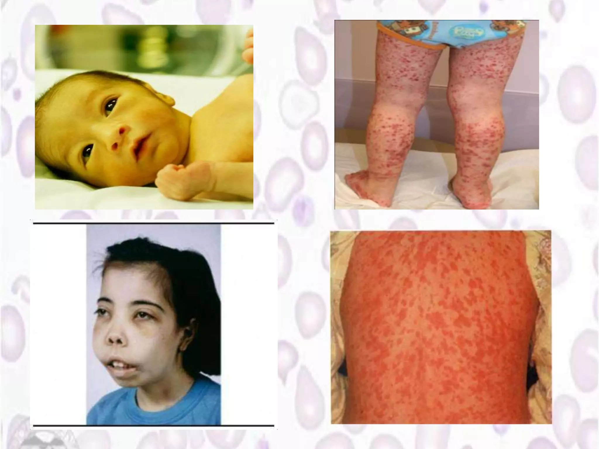 a child with anaemia - an approach | PPTX