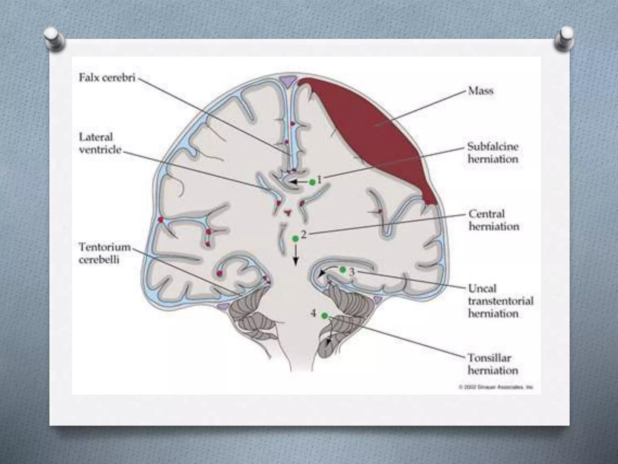 Approach to a child with coma | PPTX