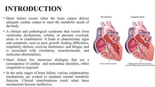 Approach to a child with Congestive Cardiac Failure 2 (1).pptx
