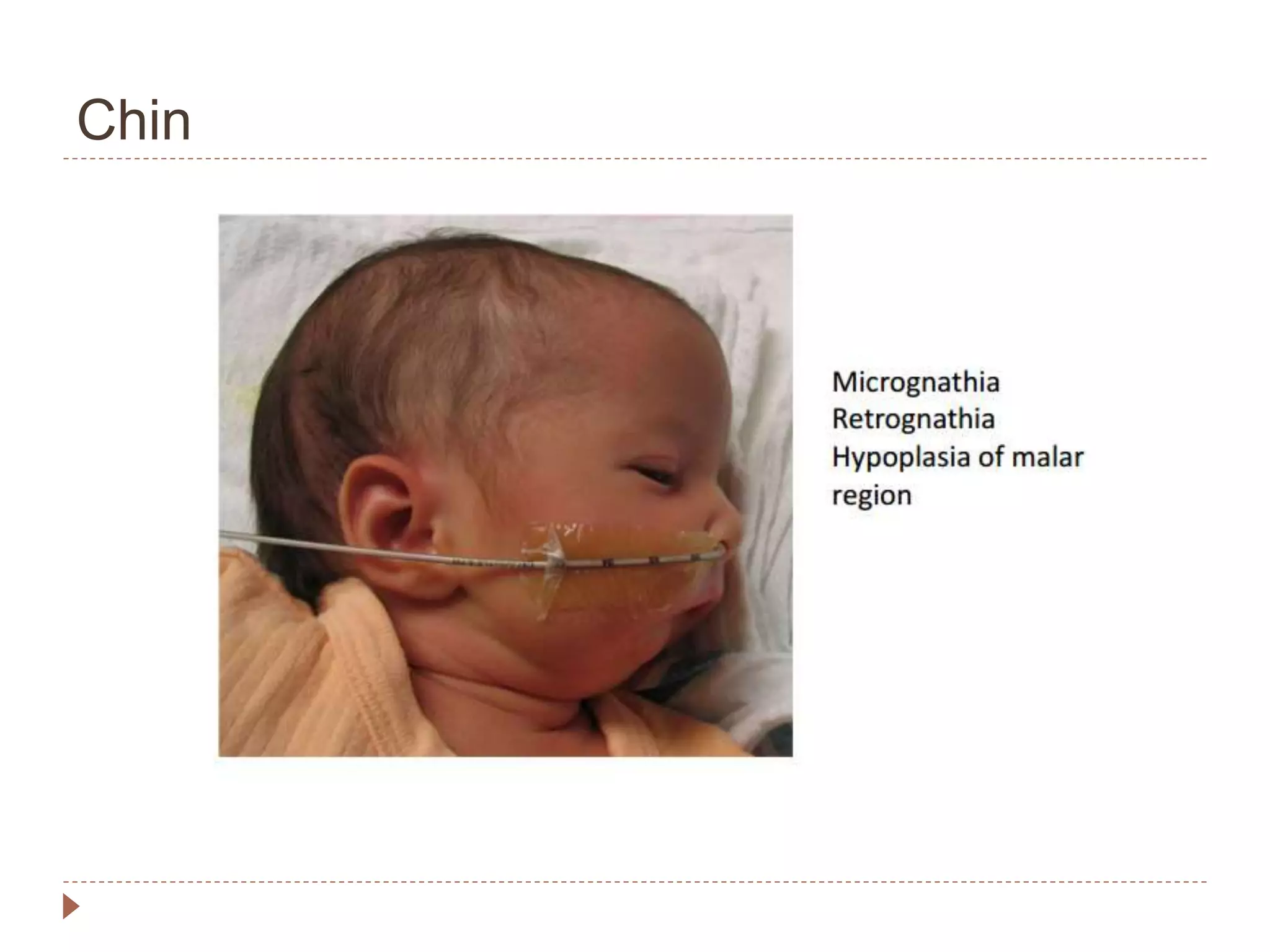 Approach to a child with dysmorphism | PPTX