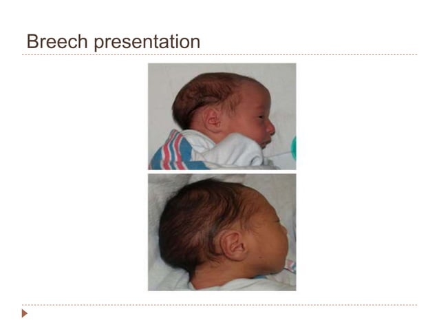 Approach to a child with dysmorphism | PPTX | Pregnancy | Reproductive ...