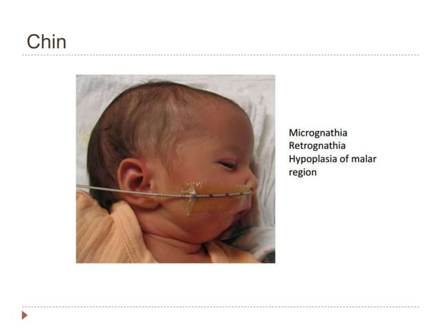 Approach to a child with dysmorphism | PPTX | Pregnancy | Reproductive ...