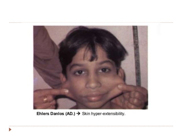 Approach to a child with dysmorphism | PPTX | Pregnancy | Reproductive ...