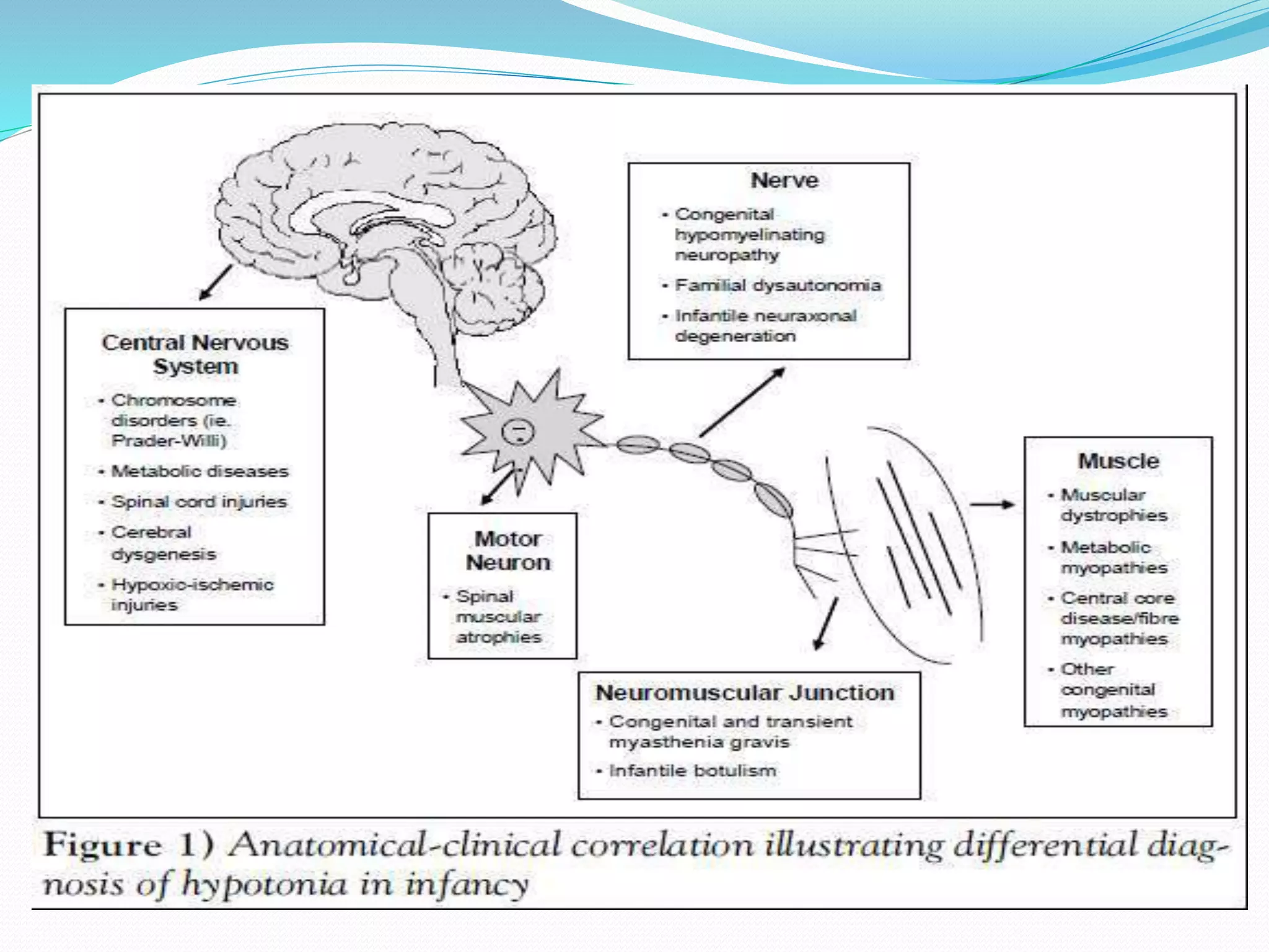 Approach to a child with hypotonia | PPTX