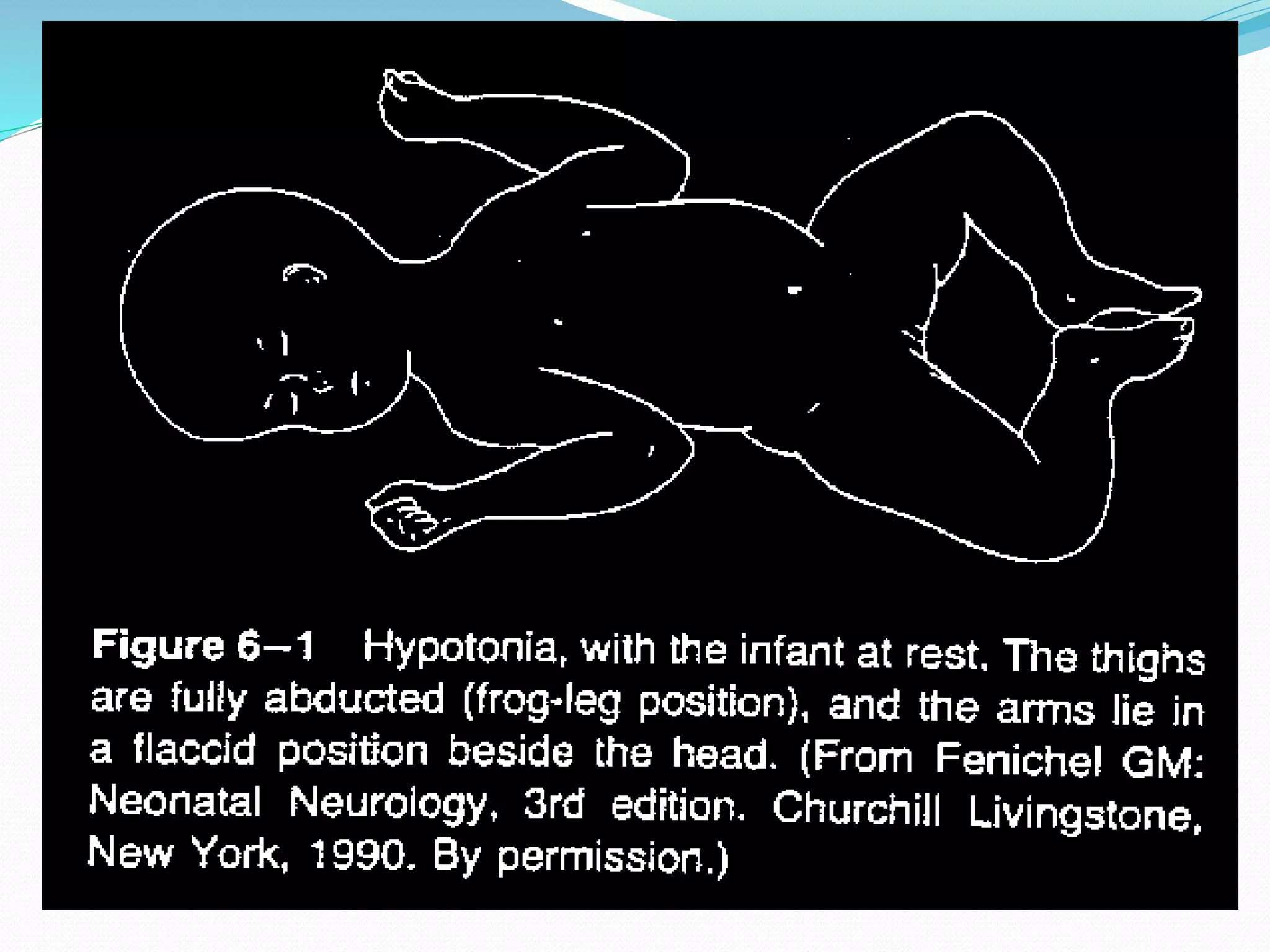 Approach to a child with hypotonia | PPTX