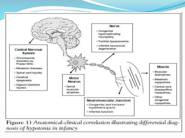 Approach to a child with hypotonia | PPTX | Pregnancy | Reproductive Health