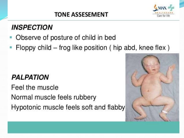 Approach to a child with hypotonia | PPTX | Pregnancy | Reproductive Health