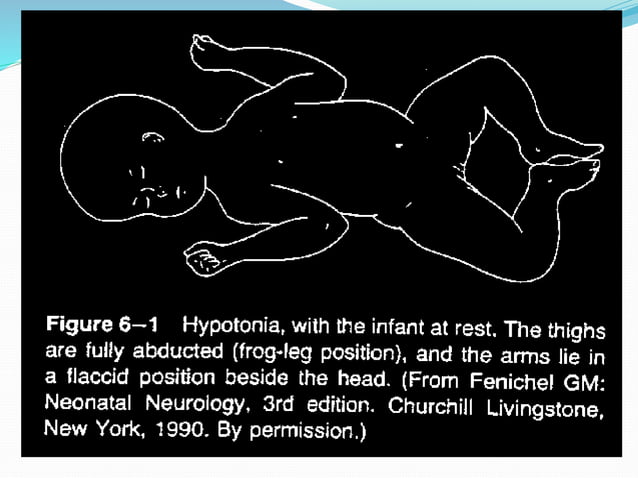 Approach to a child with hypotonia | PPTX | Pregnancy | Reproductive Health