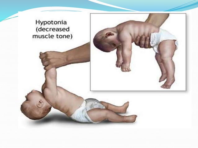 Approach to a child with hypotonia | PPTX | Pregnancy | Reproductive Health