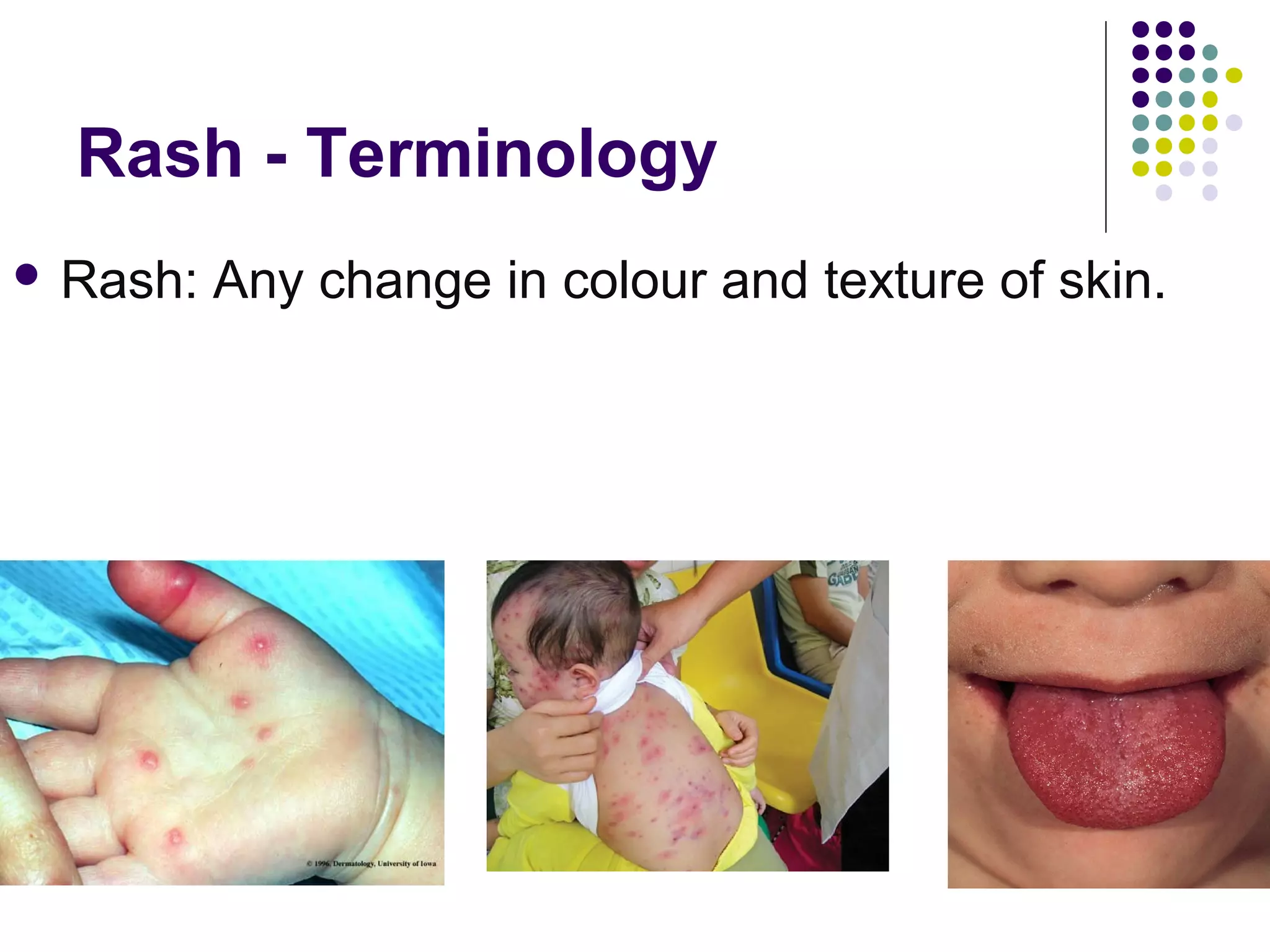 Approach to a_child_with_rash[1] | PPT