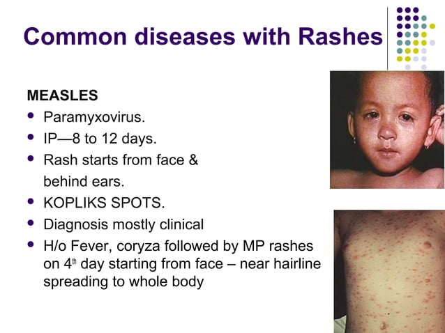 Approach to a_child_with_rash[1] | PPT | Skin and Dermatology ...