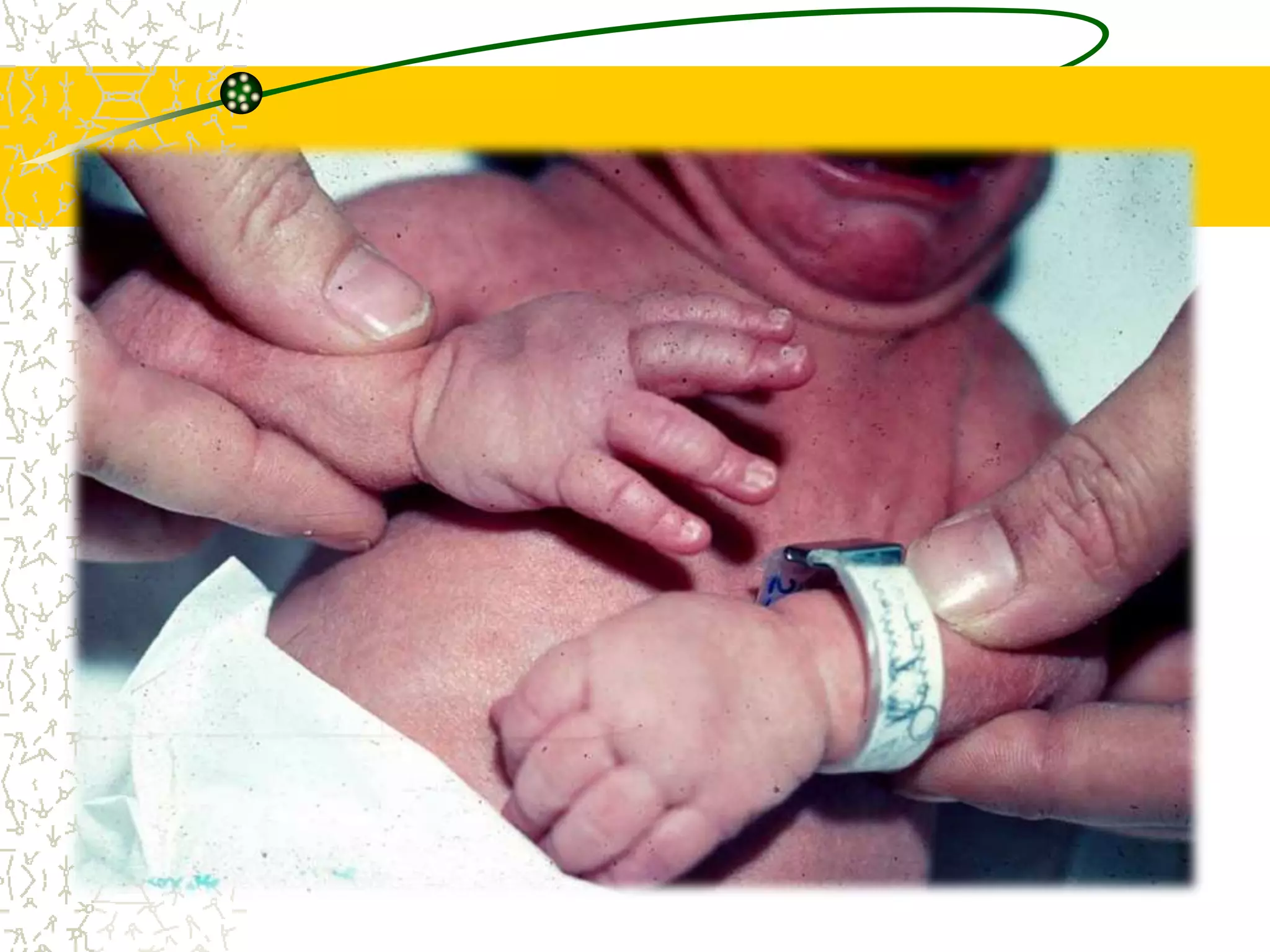 Approach to a child with short stature AG | PPTX