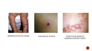 APPROACH TO ACUTE FEBRILE ILLNESS- DIAGNOSIS AND MANAGEMENT | PPTX ...