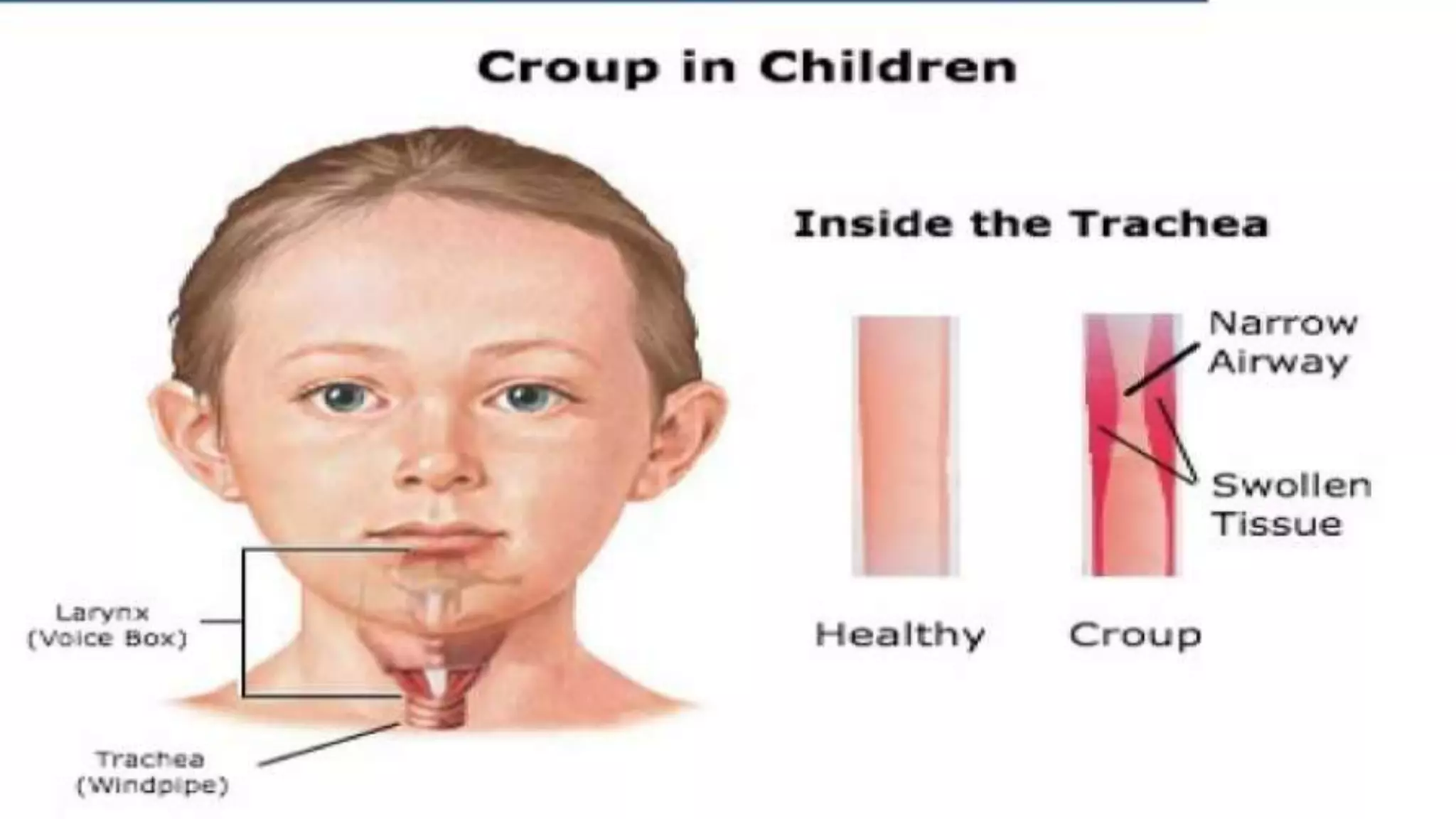 Approach to Acute infective upper airway obstruction (infective stridor ...