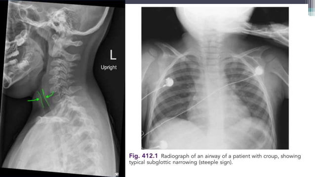 Approach to Acute infective upper airway obstruction (infective stridor ...