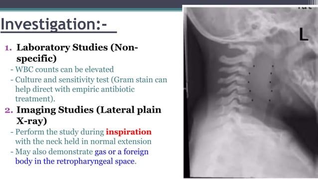 Approach to Acute infective upper airway obstruction (infective stridor ...