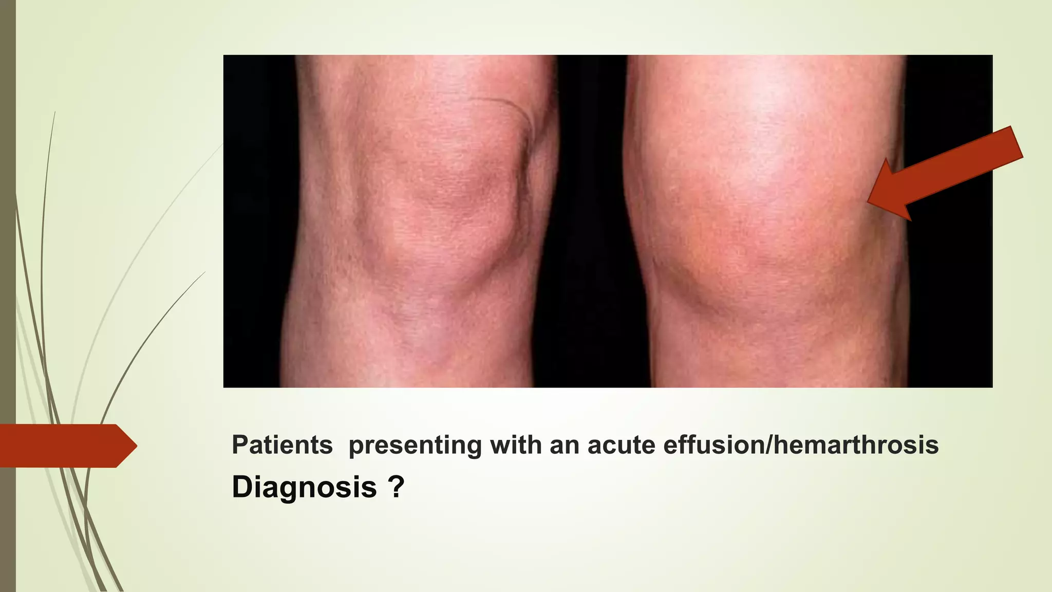 Approach to acute knee injuries (knee injury) | PPTX