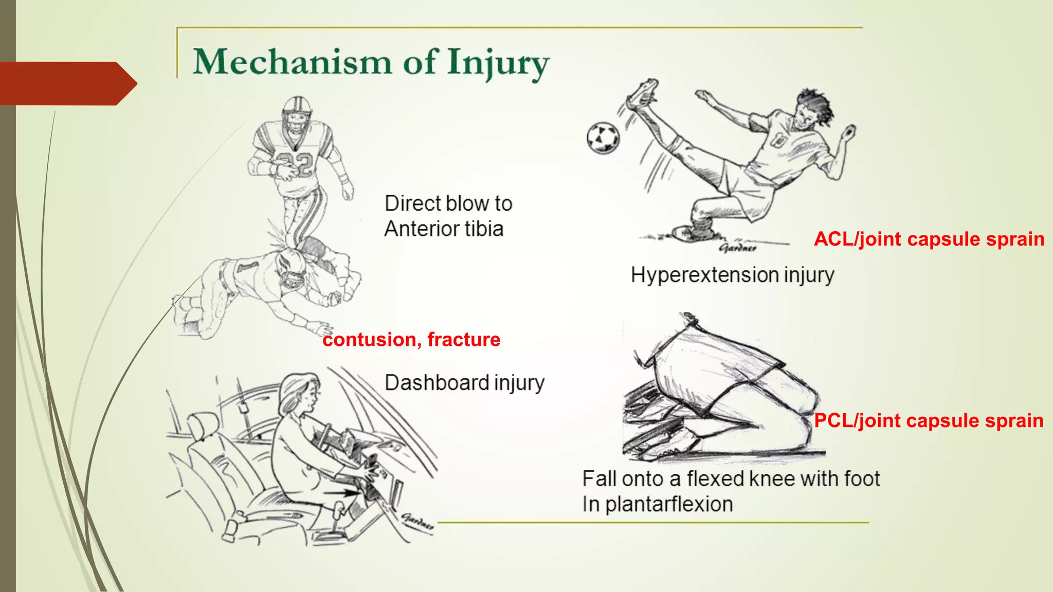Approach to acute knee injuries (knee injury) | PPTX