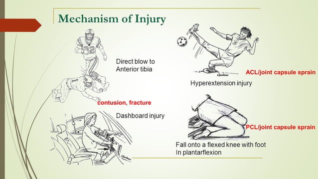 Approach to acute knee injuries (knee injury) | PPTX | Death, Injury ...