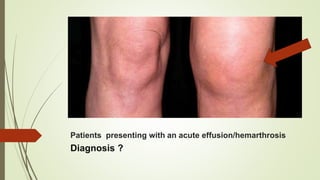 Management Of Acute Hemarthrosis In Hemophilia (Including, 51% OFF
