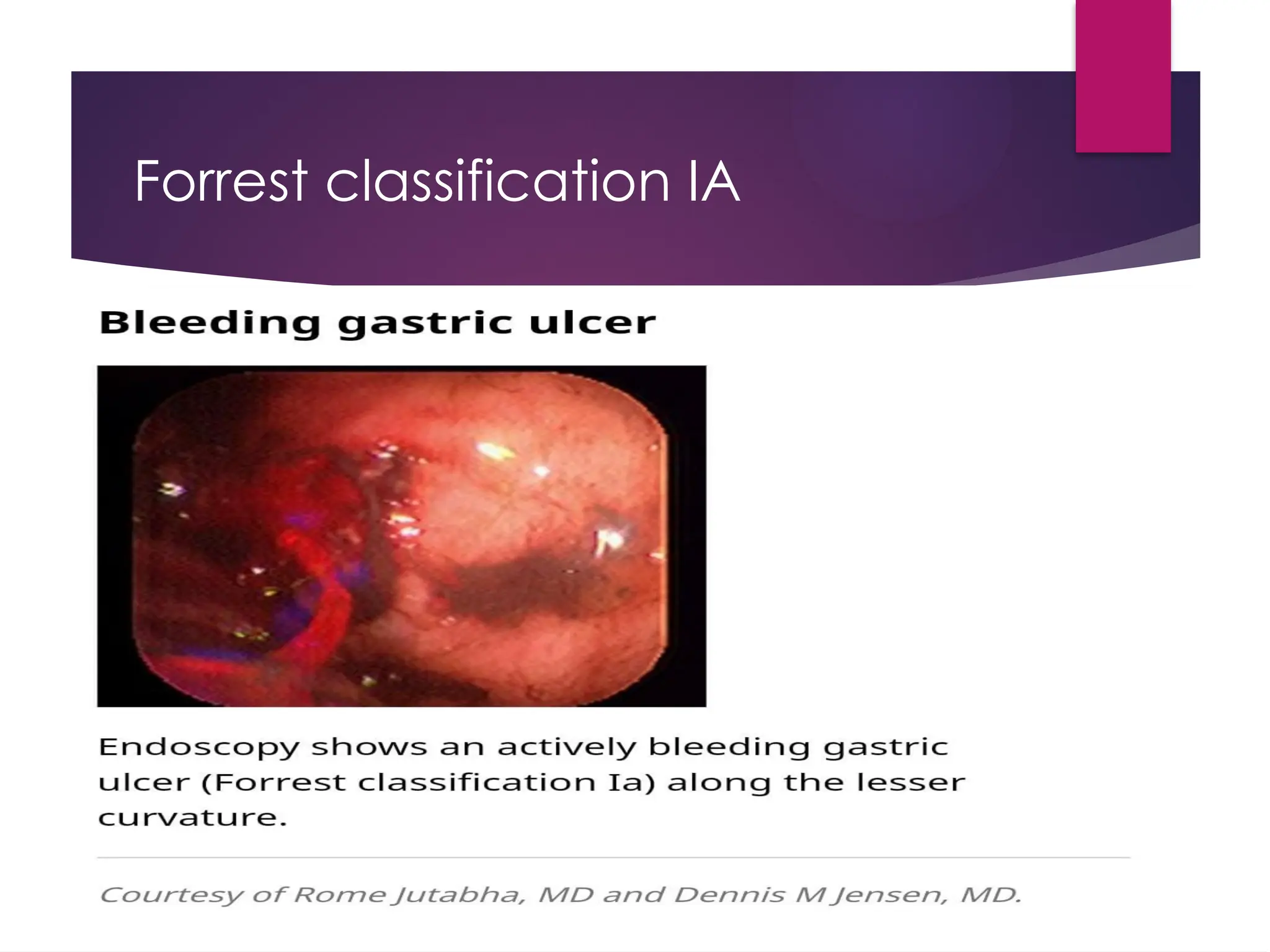 Approach to acute upper gastrointestinal bleeding(1) (1)-5(3).pptx