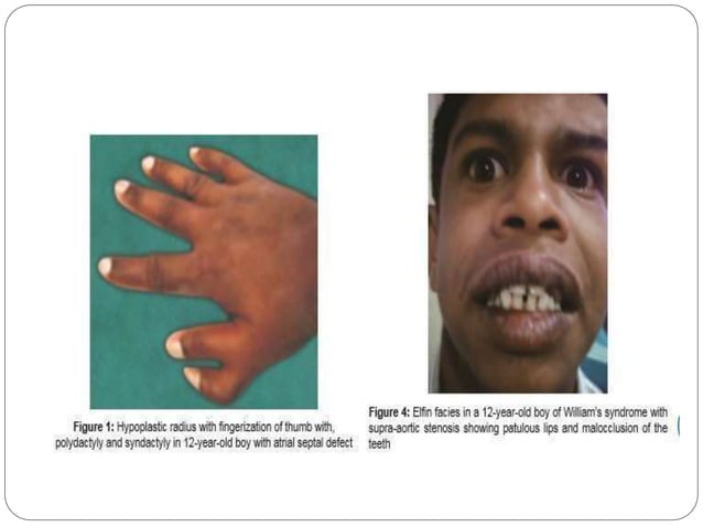 approachtoacyanoticcongenitalheartdiseasesbynag-160721044129.pptx