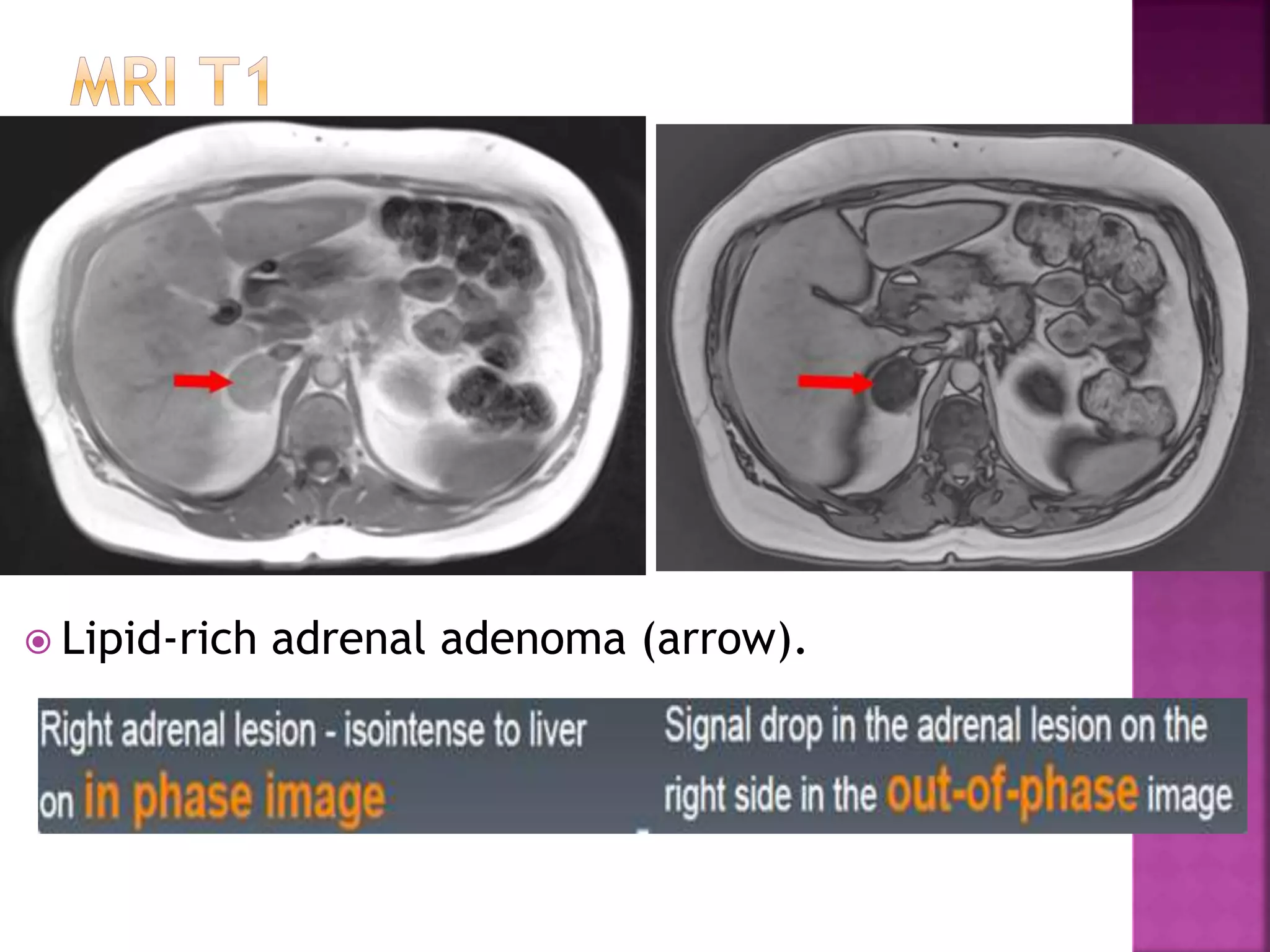 Approach to adrenal incidentaloma | PPTX