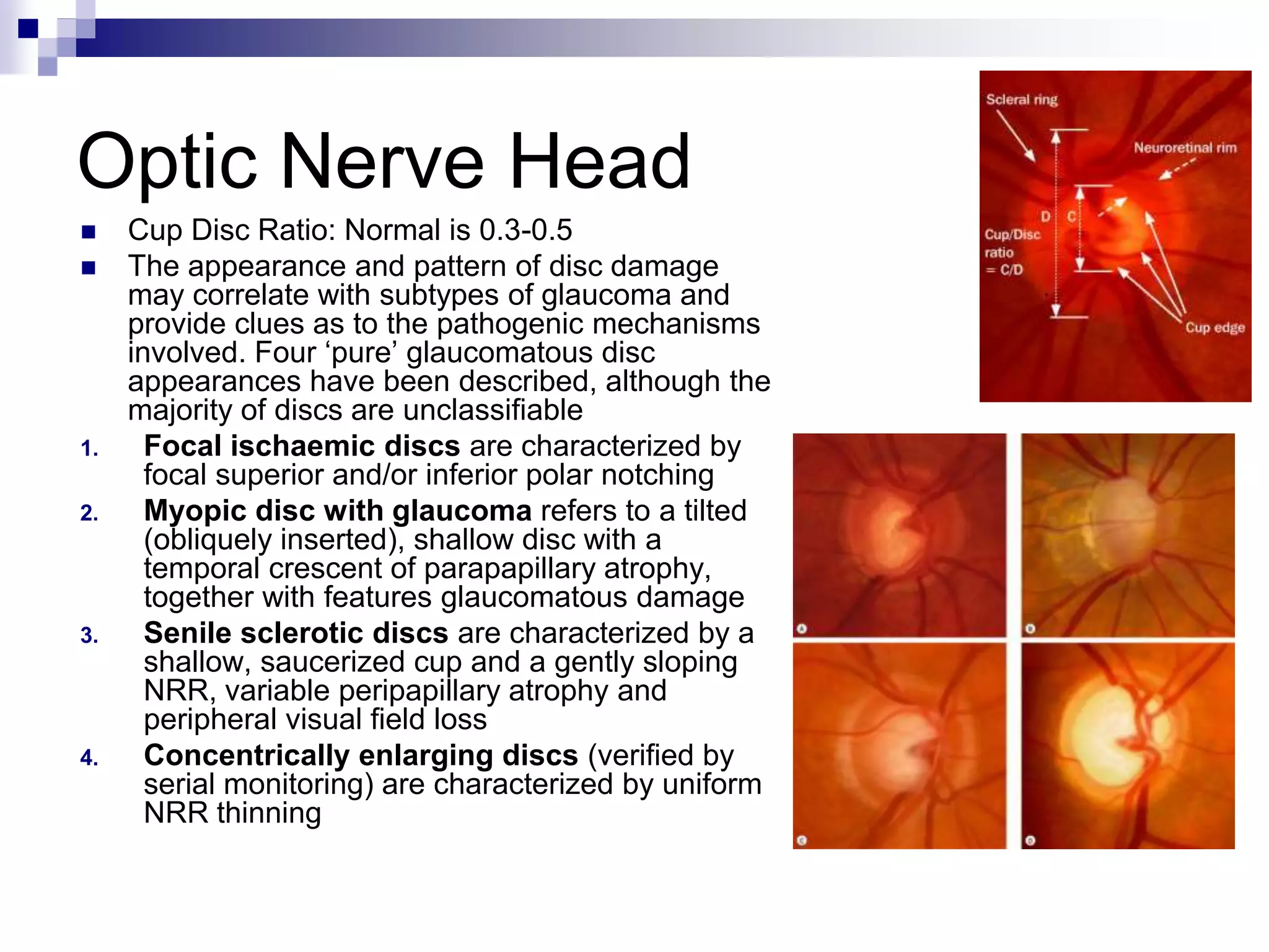 Approach to a glaucoma | PPTX