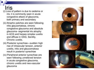 Approach to a glaucoma | PPTX