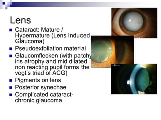 Approach to a glaucoma | PPTX