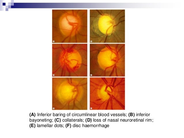 Approach to a glaucoma