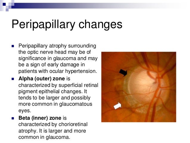 Approach to a glaucoma