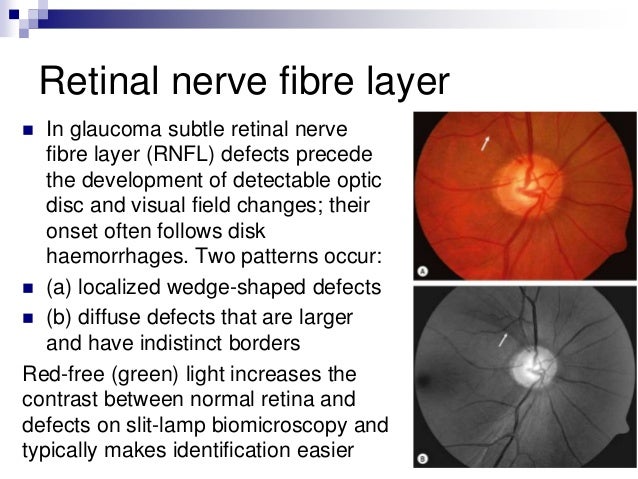 Approach to a glaucoma
