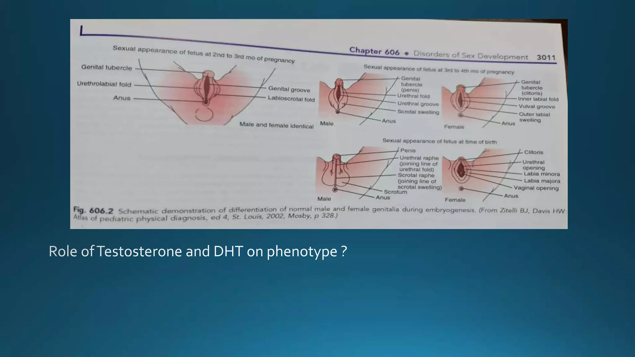 Approach to ambiguous genitalia by Dr. Asad.pptx