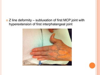 Approach to and recent advances in management of rheumatoid arthritis ...